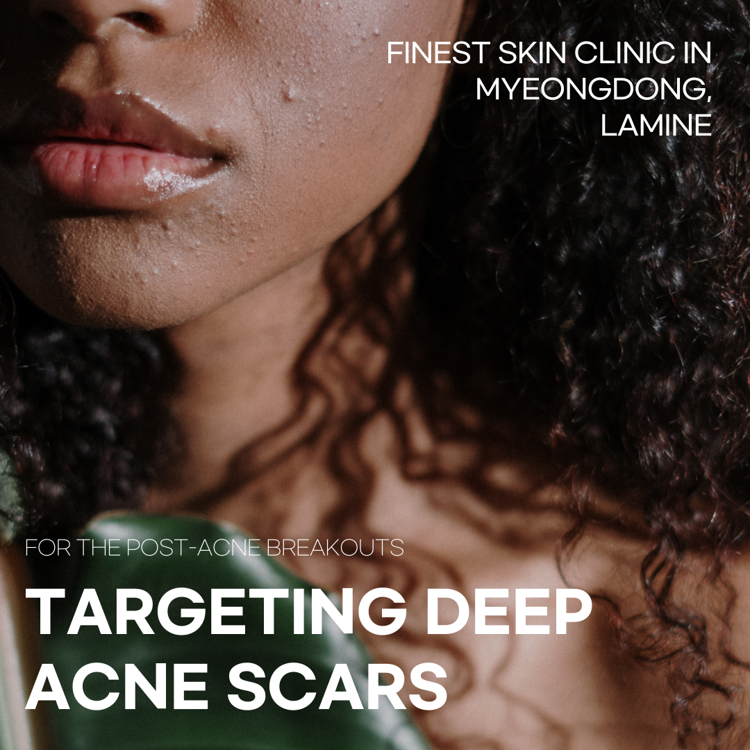 Targeting Deep Acne Scars – Korea Skin Clinic in Myeong-dong