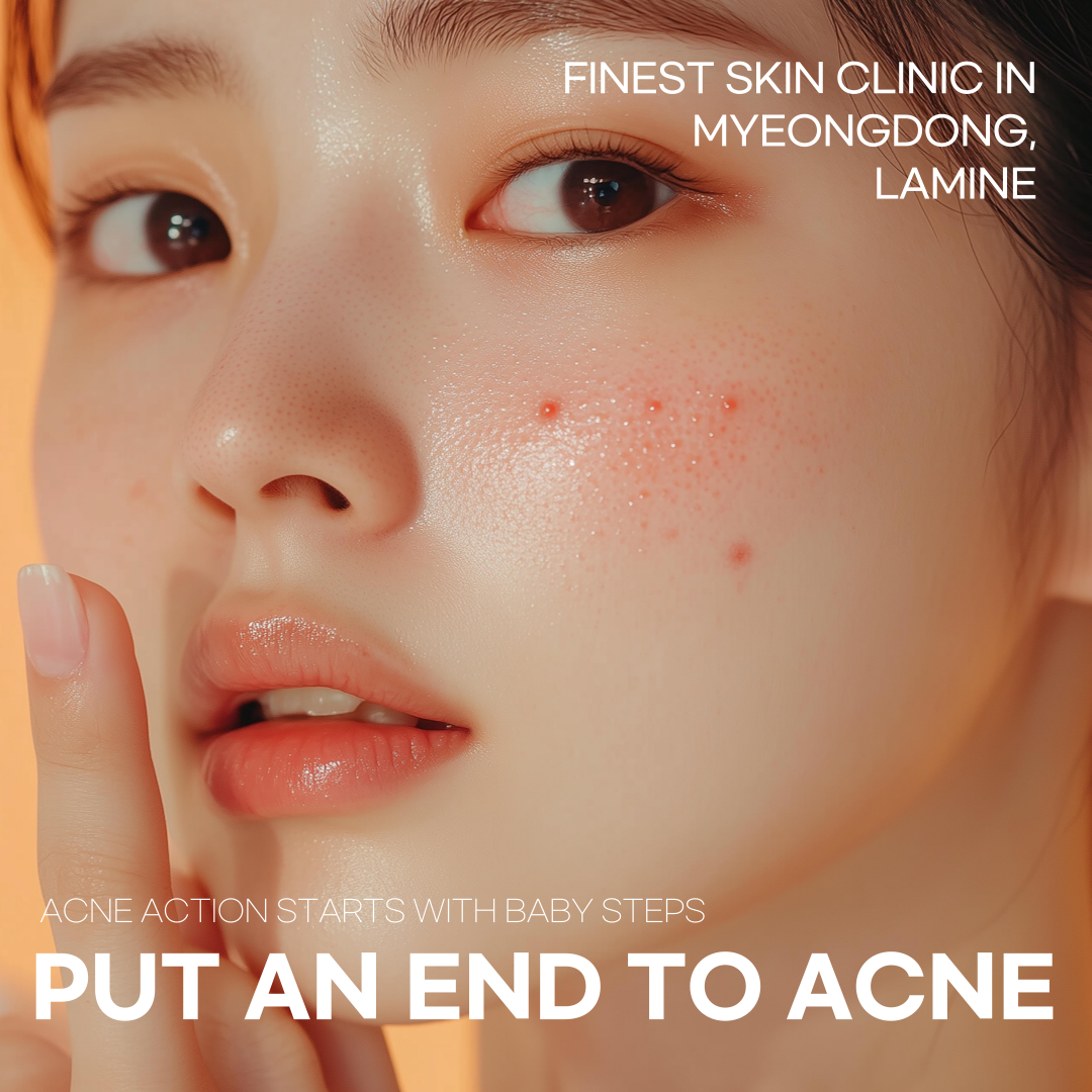 Put An End to Acne – Korea Skin Clinic in Myeong-dong