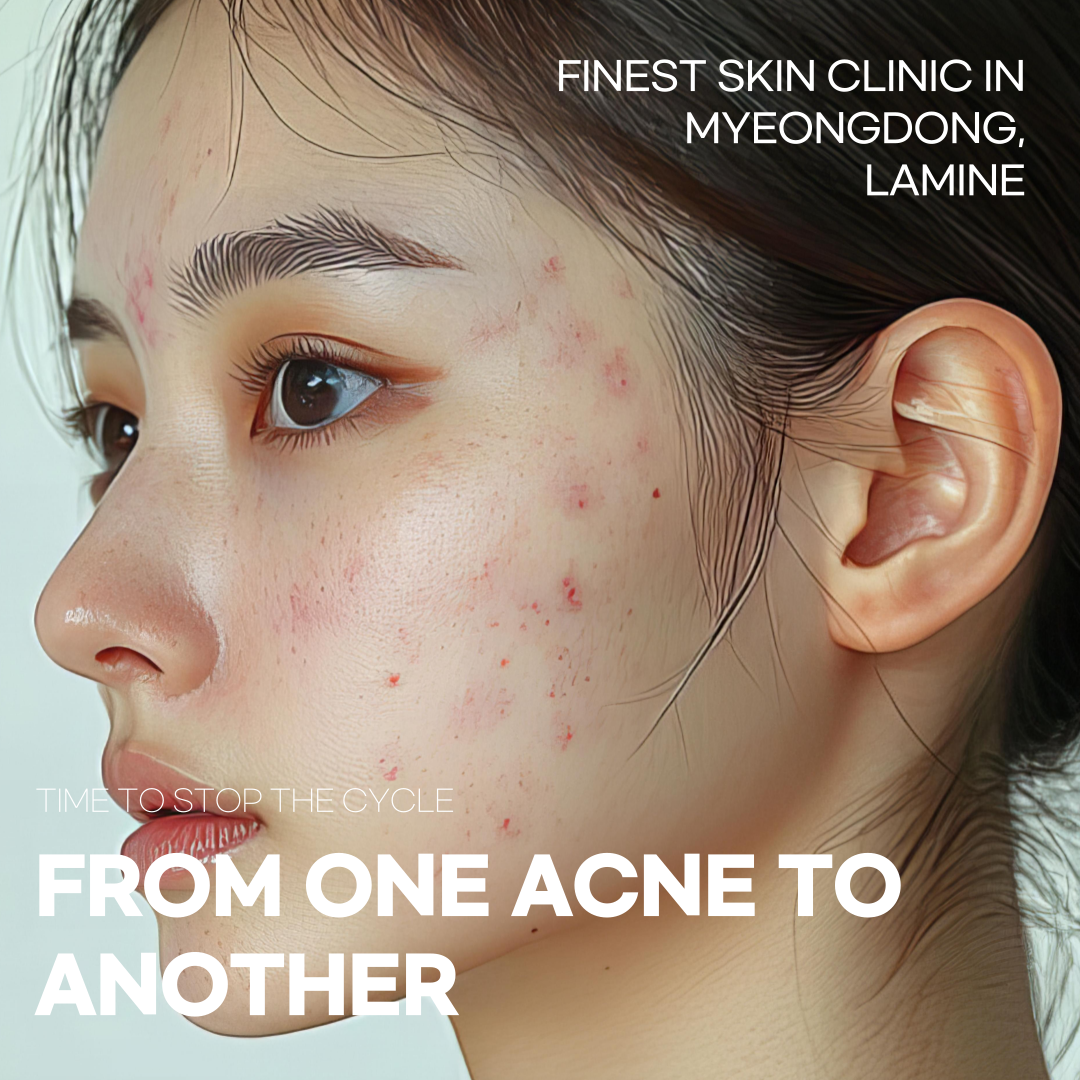 Acne Programs – Korea Skin Clinic in Myeong-dong